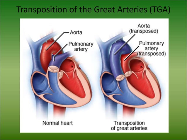 congenital_heart_diseases_in_adults.ppt | Heart and Cardiovascular ...