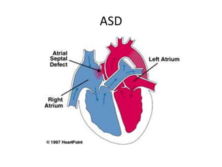 Congenital heart diseases in children | PPTX