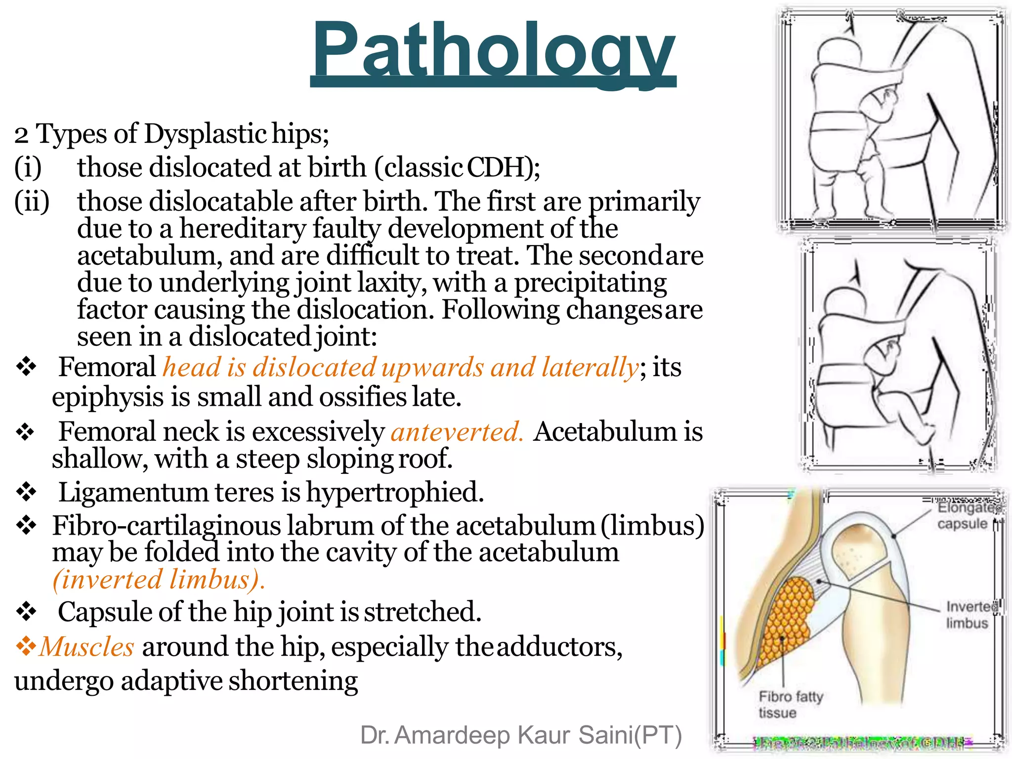 congenitalhipdislocation-181019181229.pptx