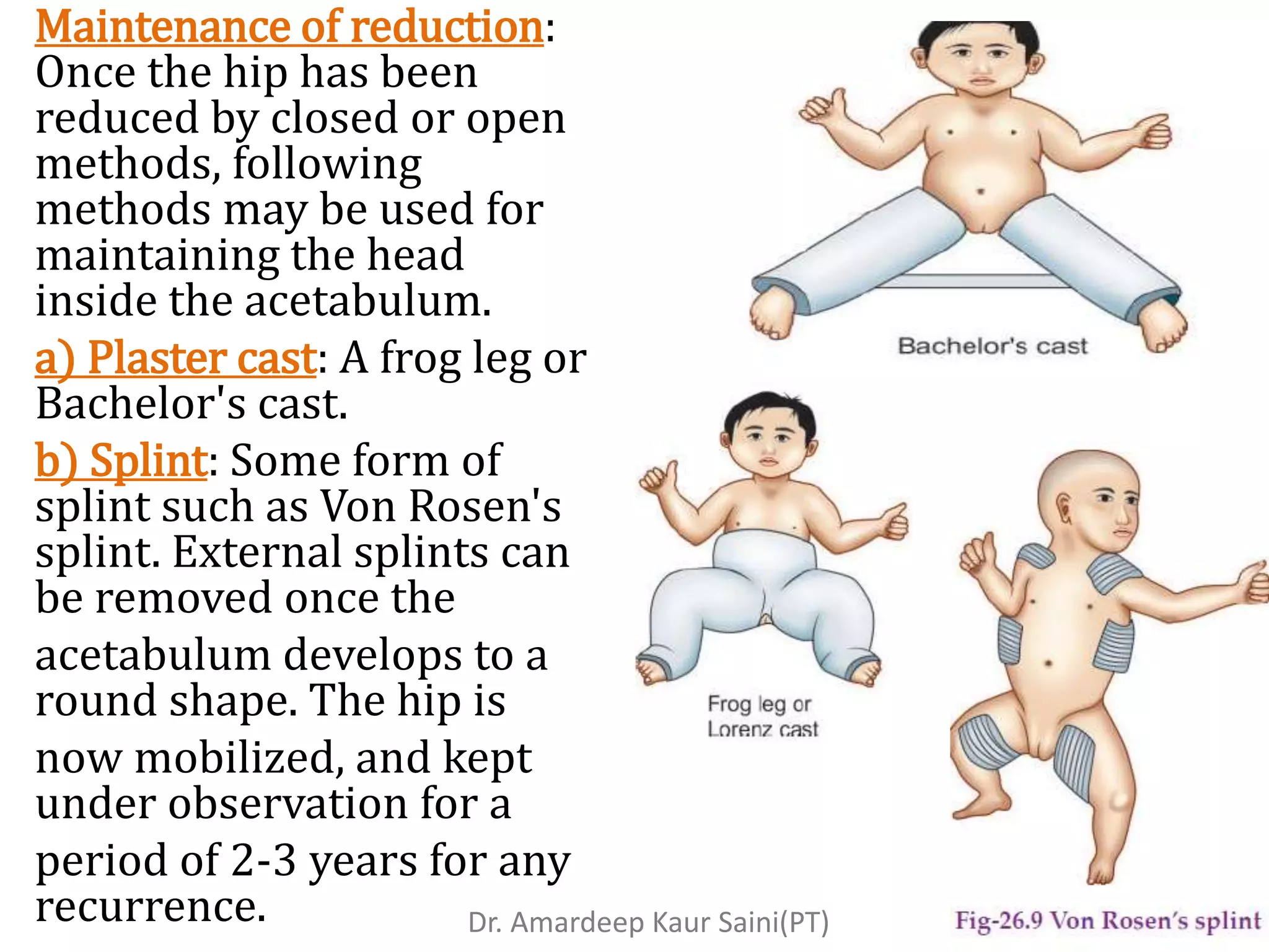 Congenital hip dislocation | PPTX