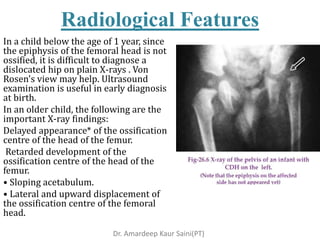 Congenital hip dislocation | PPTX