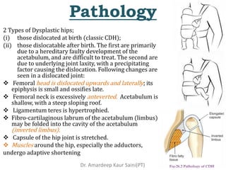 Congenital hip dislocation | PPTX