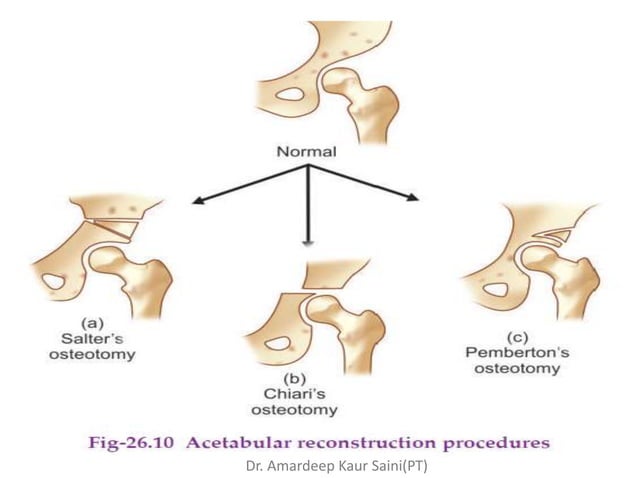 Congenital hip dislocation