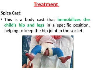 congenital hip dislocation .pptx