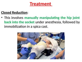 congenital hip dislocation .pptx