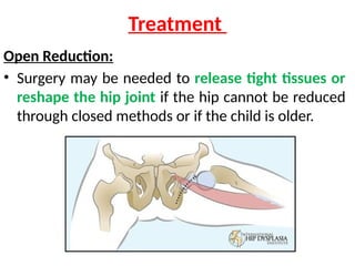 congenital hip dislocation .pptx
