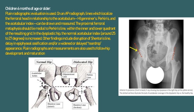 ppt aboout congenital hip dysplasia.pptx