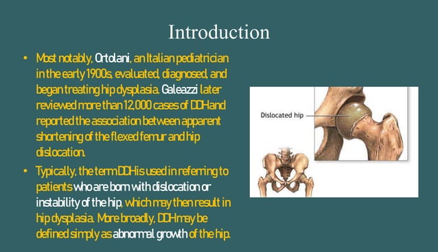 ppt aboout congenital hip dysplasia.pptx