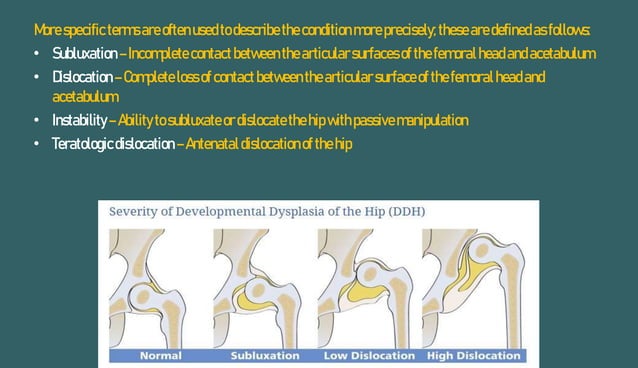 ppt aboout congenital hip dysplasia.pptx