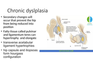 Congenital Hip Dysplasia involving subluxation | PPT