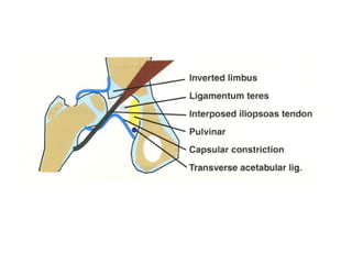 Congenital Hip Dysplasia involving subluxation | PPTX