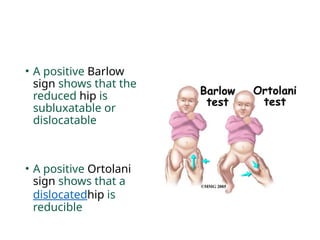 Congenital Hip Dysplasia involving subluxation | PPT