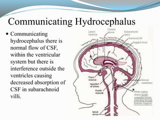 Hydrocephalus | PPTX