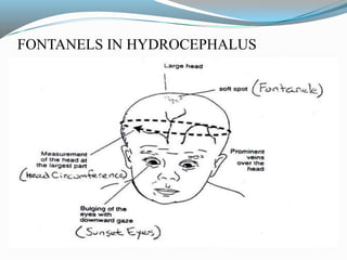 Hydrocephalus | PPTX