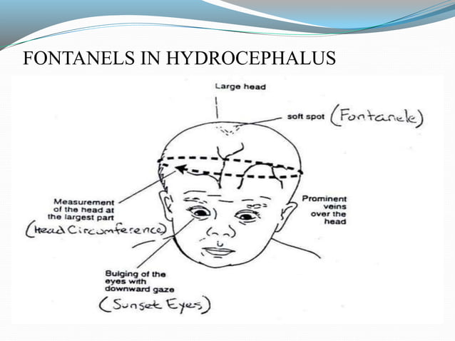 Hydrocephalus | PPTX