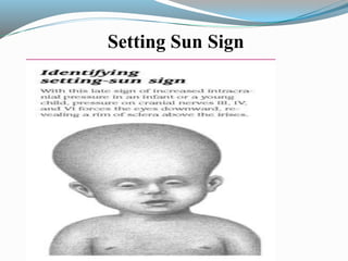 Hydrocephalus | PPTX