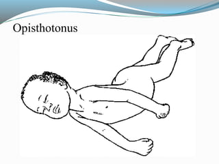 Hydrocephalus | PPTX