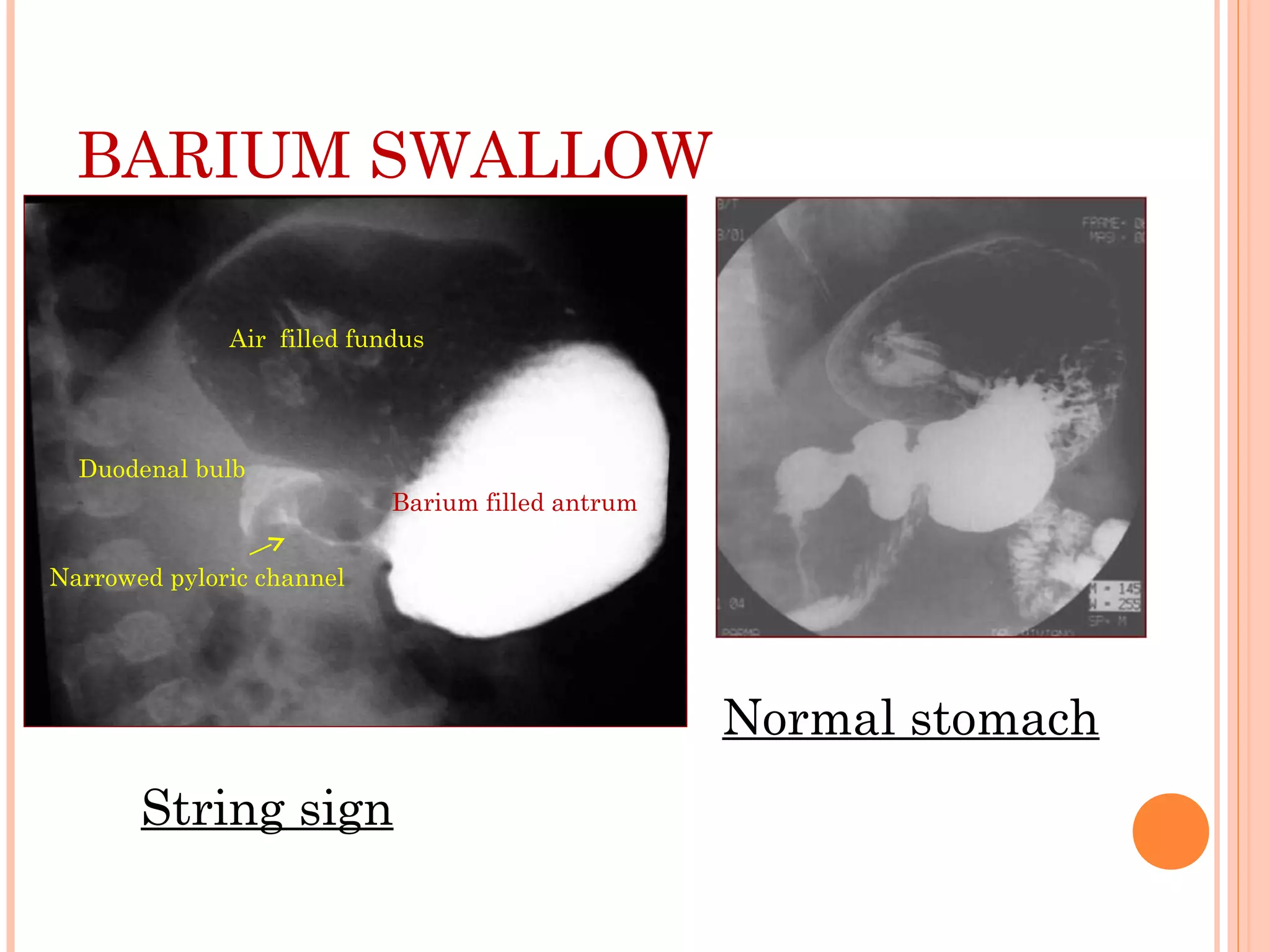 Congenital hypertrophic pyloric stenosis | PPT