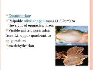 Pyloric Stenosis Olive Shaped Mass