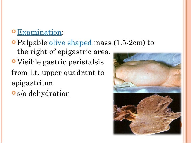 Congenital hypertrophic pyloric stenosis