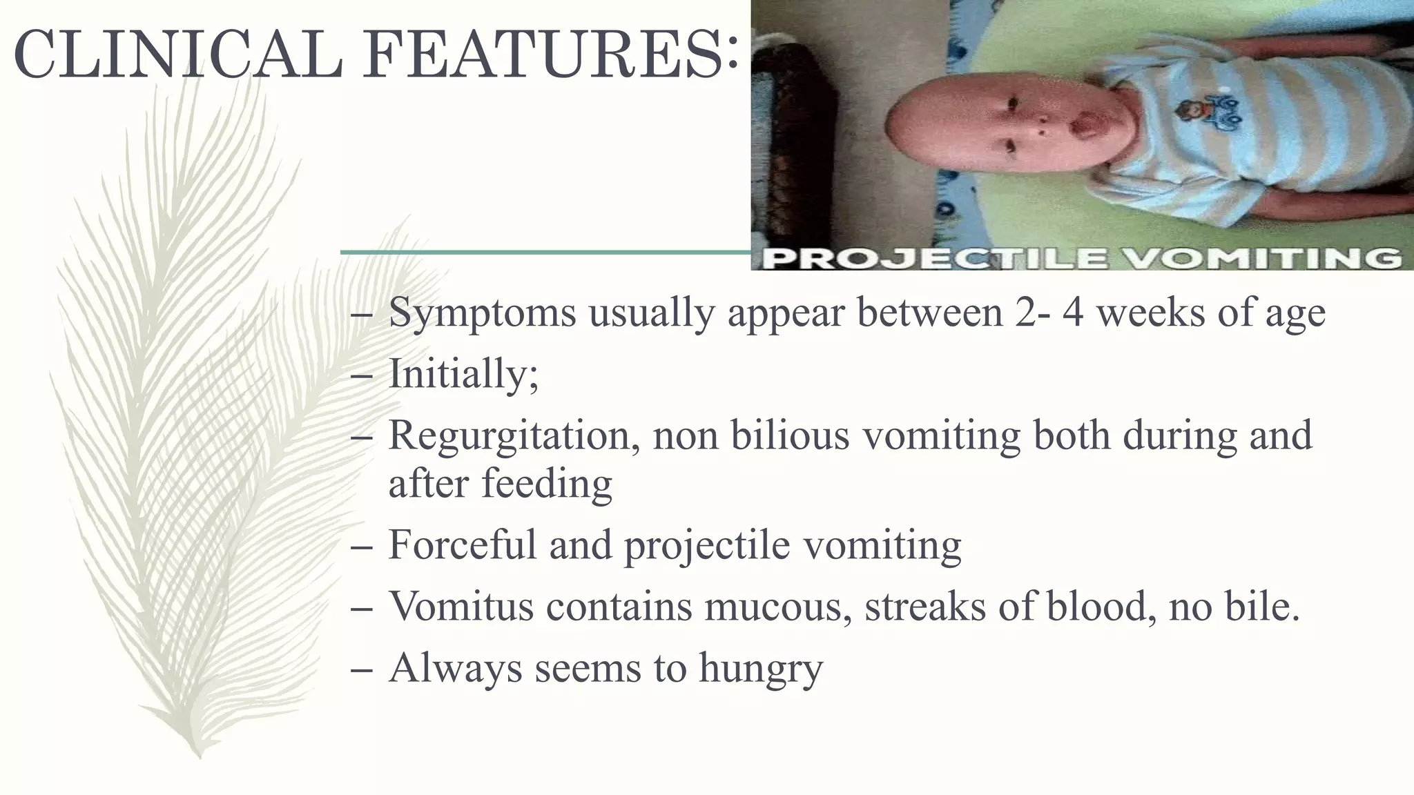 Congenital hypertrophic pyloric stenosis | PPTX