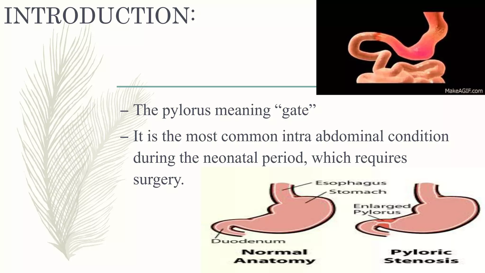 Congenital hypertrophic pyloric stenosis | PPTX