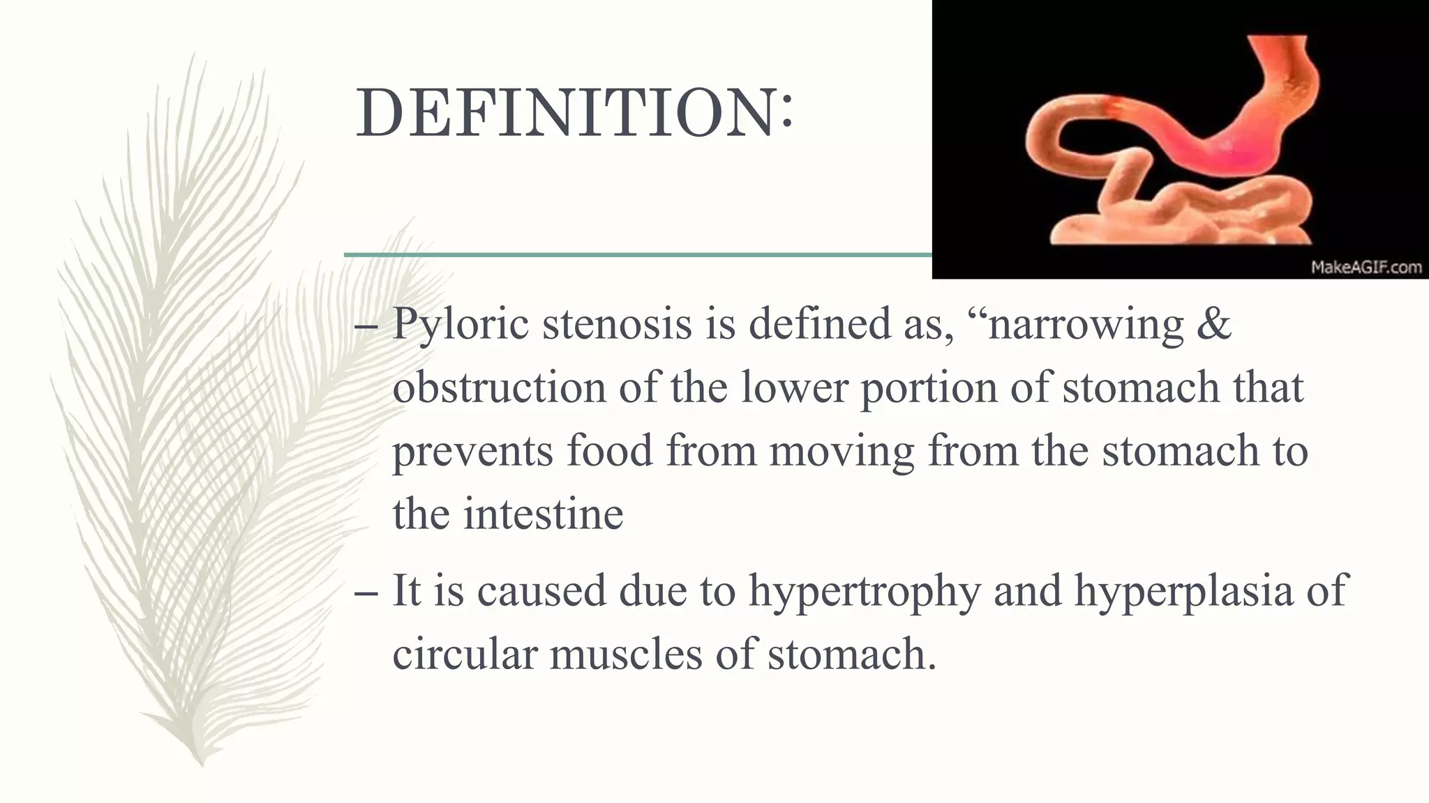 Congenital hypertrophic pyloric stenosis | PPTX