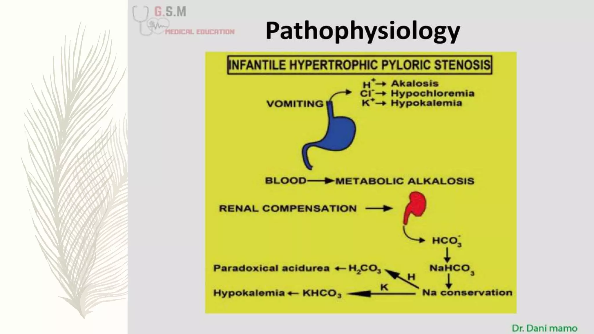 Congenital hypertrophic pyloric stenosis | PPTX