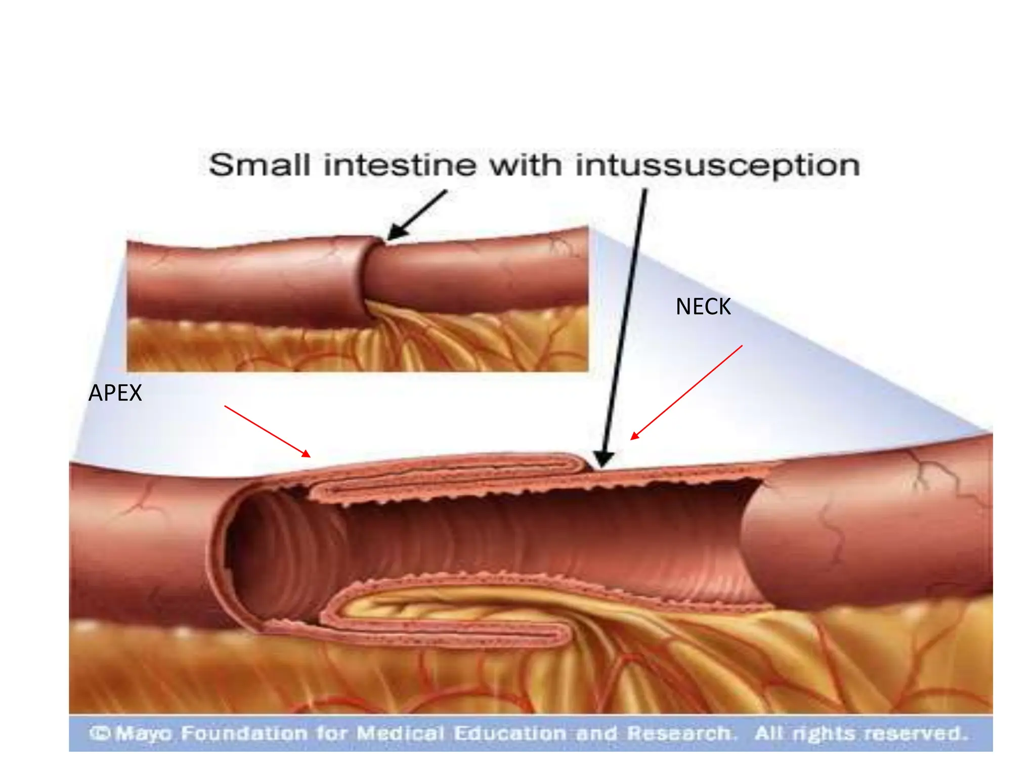 congenitalhypertrophicpyloricstenosis.pptx