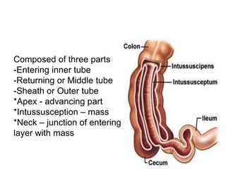 congenitalhypertrophicpyloricstenosis.pptx