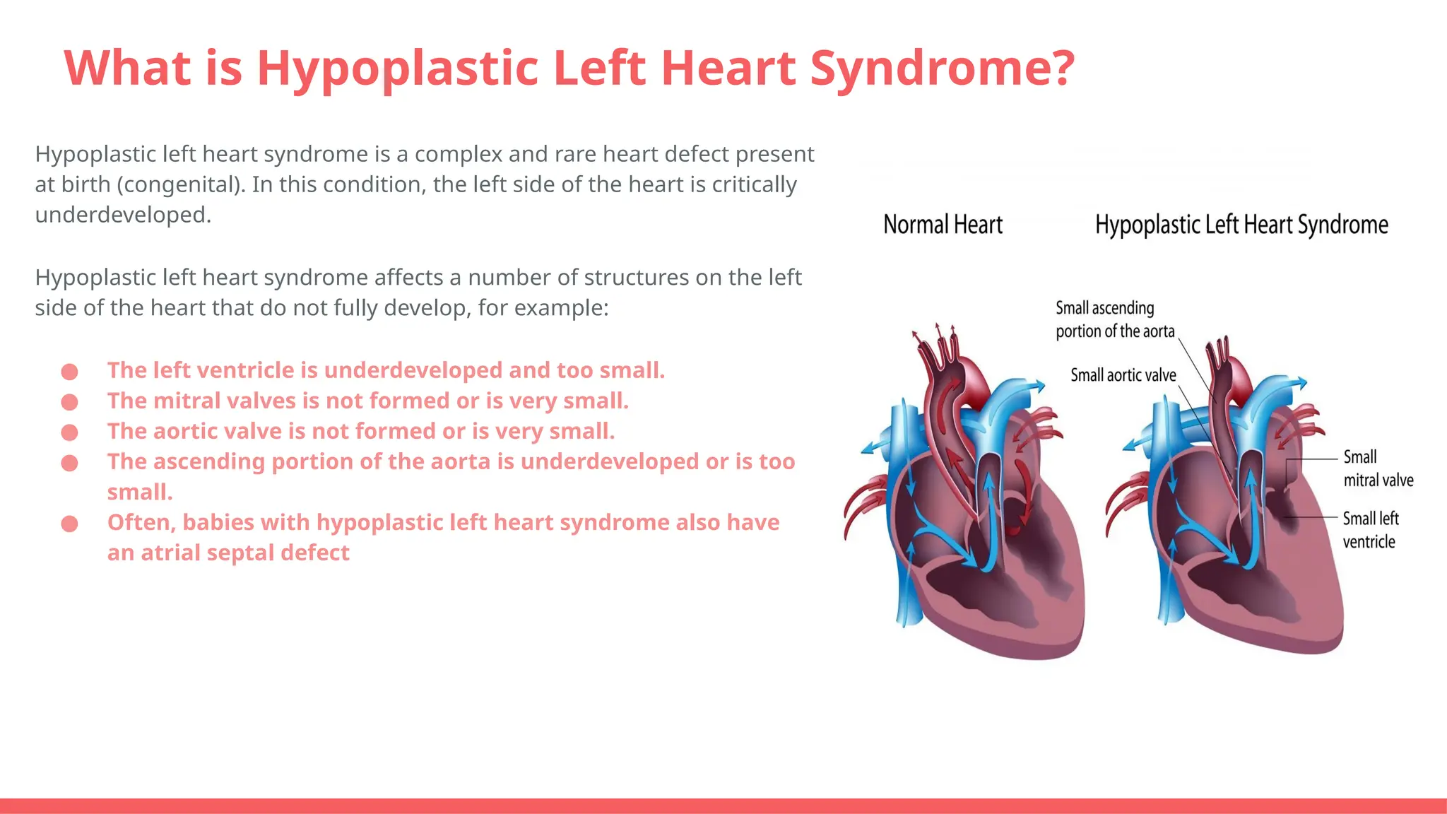 Congenital hypoplastic left heart syndrome.pptx