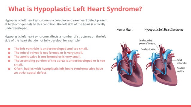 Congenital hypoplastic left heart syndrome.pptx