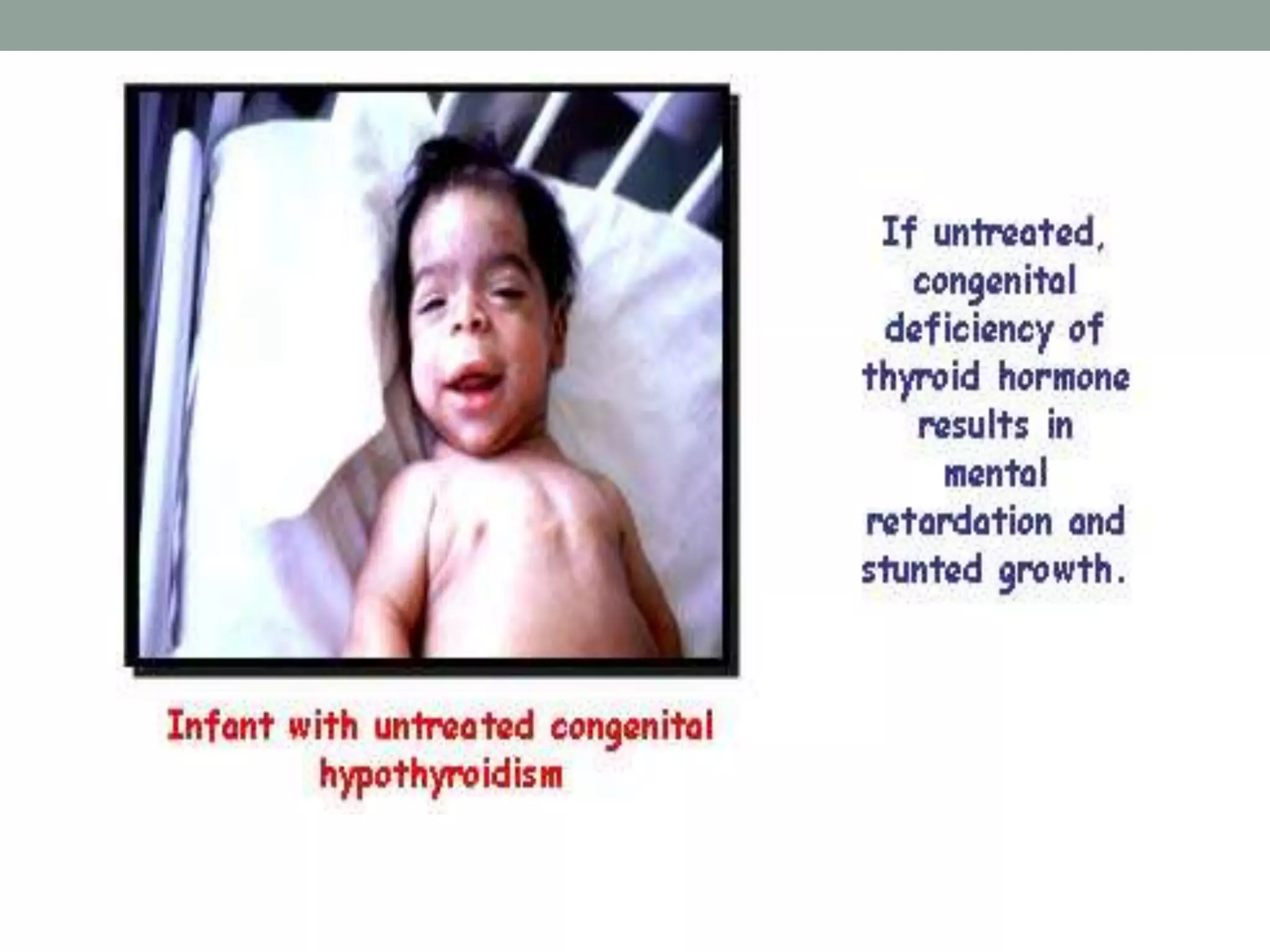 Congenital hypothyroidism | PPTX