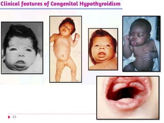 Congenital hypothyroidism | PPTX