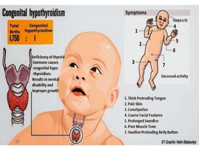 Congenital hypothyroidism