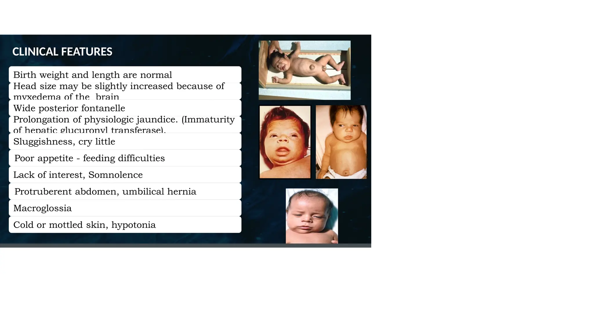 Congenital hypothyroidism pediatrics.pptx