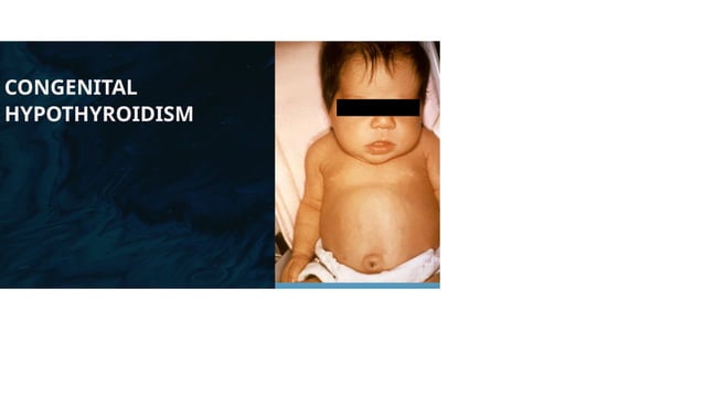 Congenital hypothyroidism pediatrics.pptx