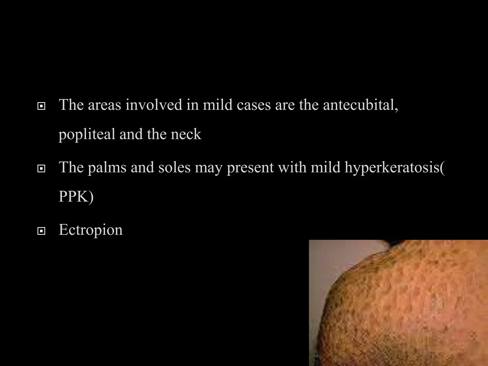 Congenital ichthyosis | PPTX