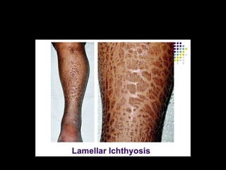 Congenital Ichthyosis