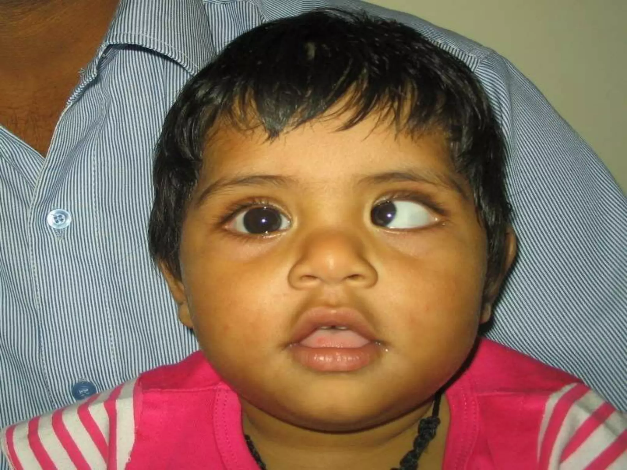 Congenital infantile esotropia | PPTX