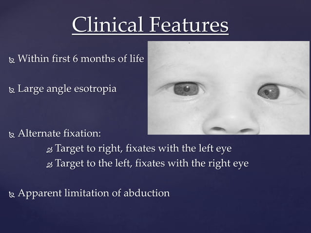 Congenital infantile esotropia | PPTX | Eye and Vision Conditions ...