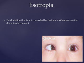 Congenital infantile esotropia | PPTX