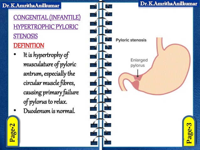 Congenital (infantile) hypertrophic pyloric stenosis by Dr.K ...