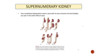Congenital Kidney Anomalies * ANOMALIES OF RENAL NUMBER * ANOMALIES OF ...