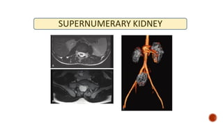 Congenital Kidney Anomalies * ANOMALIES OF RENAL NUMBER * ANOMALIES OF ...