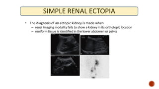 Congenital Kidney Anomalies * ANOMALIES OF RENAL NUMBER * ANOMALIES OF ...