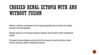Congenital Kidney Anomalies * ANOMALIES OF RENAL NUMBER * ANOMALIES OF ...
