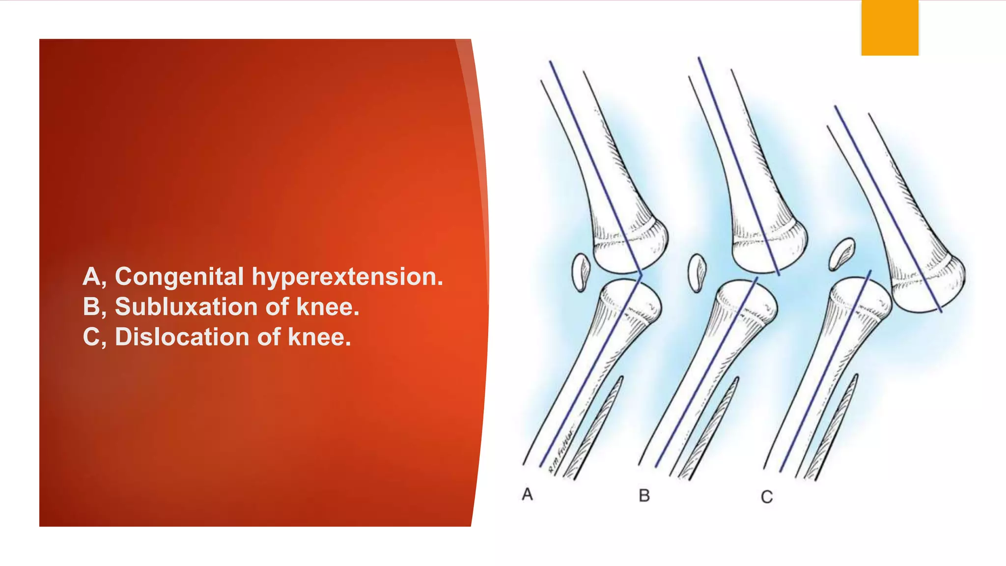 Congenital knee dislocation | PPTX