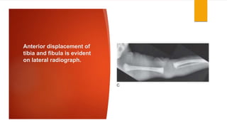Congenital knee dislocation | PPTX