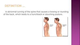 Congenital kyphosis | PPTX